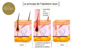 Les différents types de laser pour l'épilation en 2026